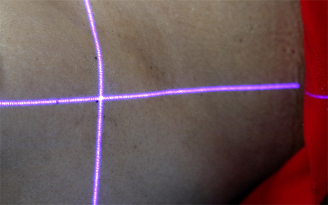 Dots mark the spot: Tattoo guides radiotherapy, benefiting patients ...